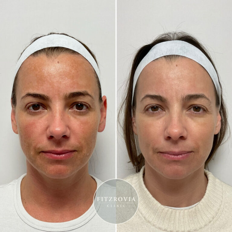 Melasma - Fitzrovia Clinic